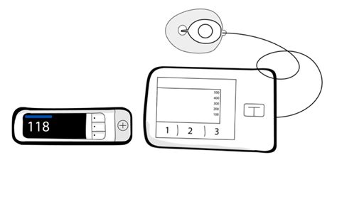 Meter And Tandem Vs Medtronic Sensor And Tandem Pump Comparación Imparcial Diabeteswise