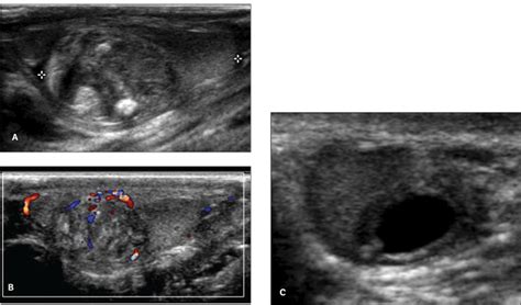 Testicular Teratoma Ultrasound