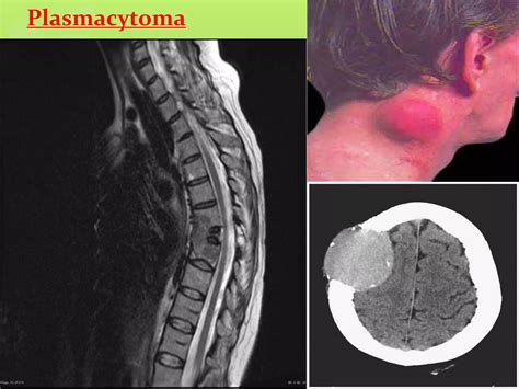 Multiple Myeloma Case Presentation Pptx