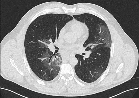 Unenhanced Chest Ct Scan Bilateral Diffuse Glass Opacities Download Scientific Diagram