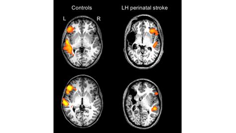 Stroke In Infants And Brain Plasticity And More Gumc Update 10 10 2022