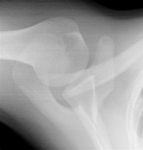 Acj Dislocation The Bone School