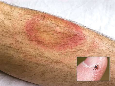 Bite Stops Here Fight Lyme Disease With Prevention Outdoor News