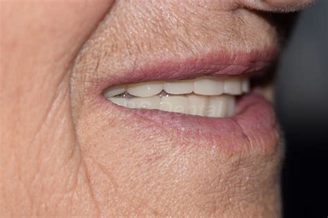 Тотални протези Дентален център Ес Би Си