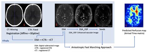Framework To Generate Perfusion Map From Ct And Cta Images In Patients