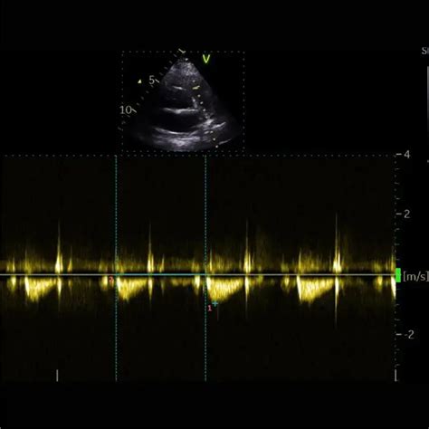Interpreting Echocardiogram Results A Comprehensive Guide For Clinicians Tricog Health
