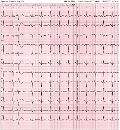 Sinus Rhythm With Normal Qrs Complexes And Intervals And A Single Ve Of