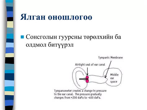 Дунд чихний архаг үрэвсэл Pptx
