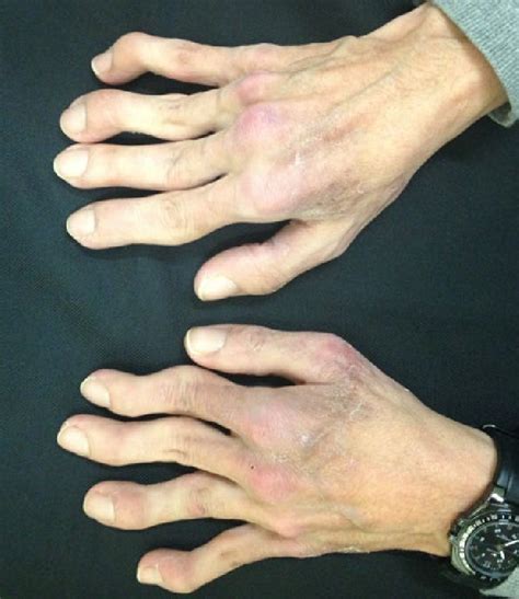 Joint Contractures And Muscle Atrophy On The Hands Authors Archive Download Scientific