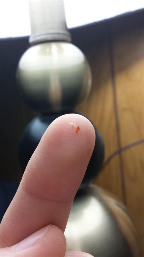 Gently Pulled A Scab Off Of A Pimple And This Came Out With It Popping