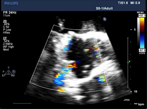 Echocardiography Color Flow Mapping Image Reflecting Mild To Moderate Download Scientific