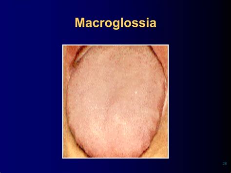 Thyroid Disorders Hyperthyroidism And Hypothyroidism Pdf