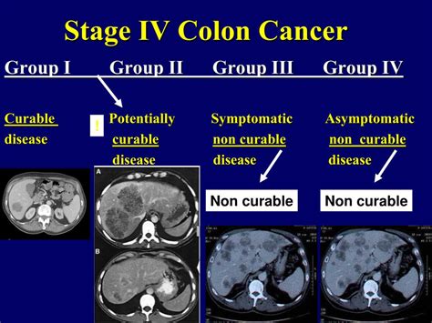 Ppt Colon Cancer Powerpoint Presentation Free Download Id845915
