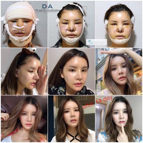 สวยยันกระดูก สาวไทยทุ่มเงินกว่า 6 ล้าน เปลี่ยนเบ้าหน้าเป็นคนละคน