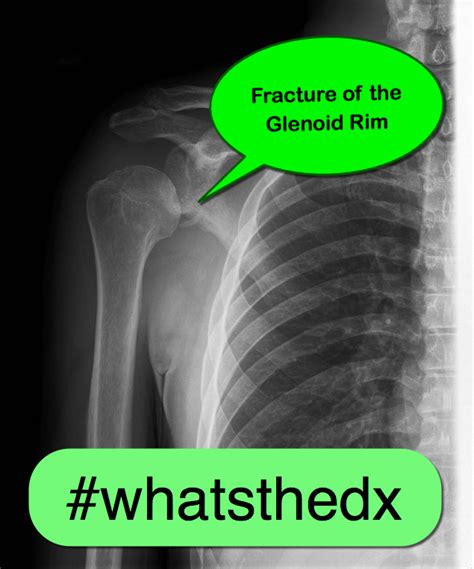 Inferior Glenoid Fracture X Ray At Elvira Pierce Blog