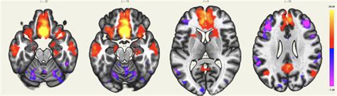 Figure 4 Regions Connected To The Subcallosal Cortex