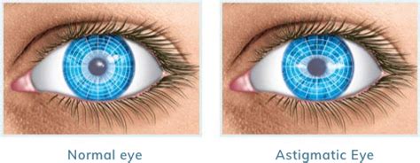 Astigmatism