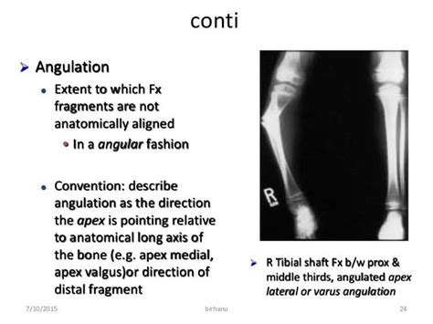 Principle Of Fracture Managment