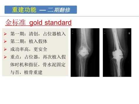 人工关节术后假体周围感染的诊断及治疗策略 好医术早读文章 好医术 赋能医生守护生命