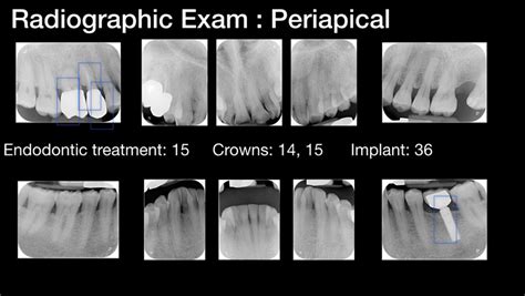 Zirconia Crown Radiograph