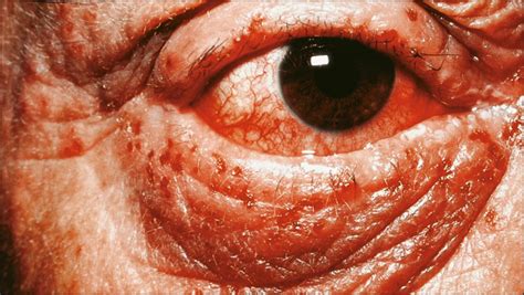 Blepharitis Overview And Classification Clinical Tree