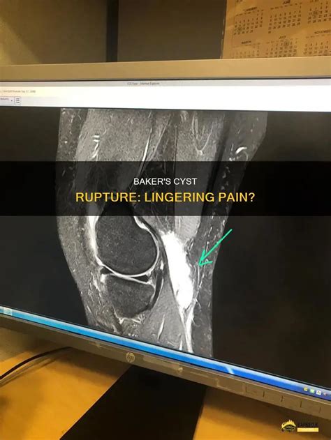Bakers Cyst Rupture Lingering Pain Shungrill