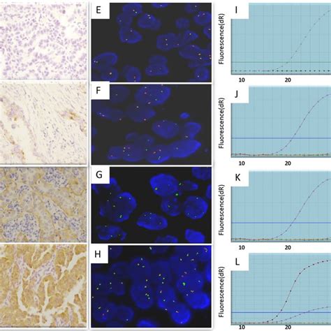 PDF Detection Of ROS1 Gene Rearrangement In Lung Adenocarcinoma Comparison Of IHC FISH And