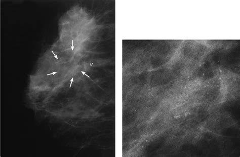Calcifications Small Round Punctate Radiology Key