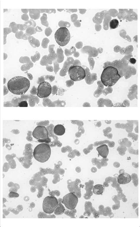 Bone Marrow On Day 6 After Admission Images Show Normal Cellularity Download Scientific