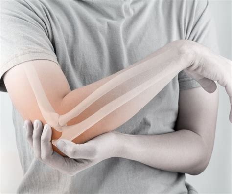 Fractura De Olecran Dr Eduard Cernat Medic Primar Ortoped