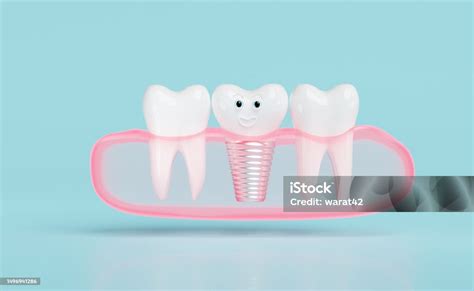 파란색 배경에 분리된 치과 임플란트가 있는 3d 잇몸 3d 렌더링 일러스트레이션 3차원 형태에 대한 스톡 사진 및 기타 이미지 3차원 형태 건강관리와 의술 건강한