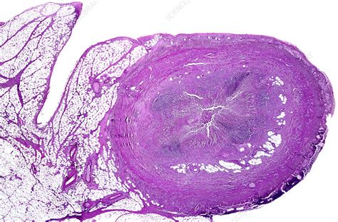 Acute Appendicitis Light Micrograph Stock Image C Science Photo Library
