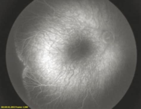 Cobblestone Degeneration