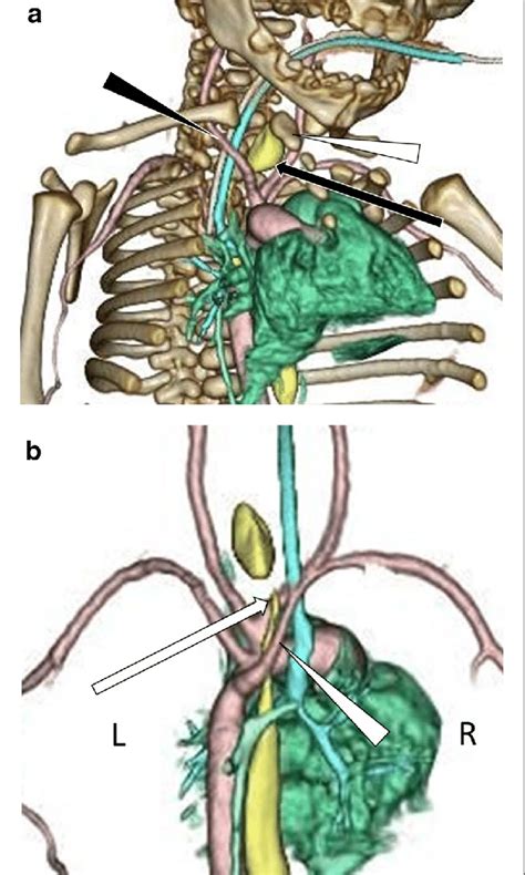 Three Dimensional Computed Tomography The Trachea Light Blue Download Scientific Diagram