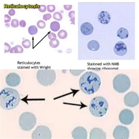 Alireza Moghaddam On Linkedin Reticulocytes Are A Useful Clinical Indicator Of Anemias And Bone