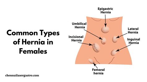 6 Most Common Hernia Types In Women Chennai Laser Gastro