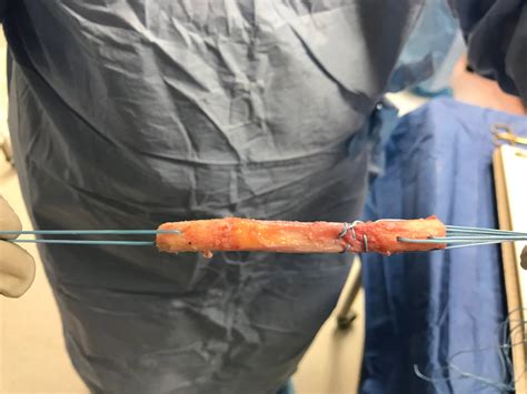 Hamstring Tendon Graft