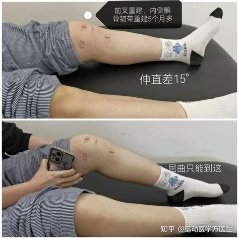 这可能是我见过最离谱的前叉重建失败案例了 知乎