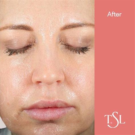 PICO FX Laser Genesis The Skin Lab