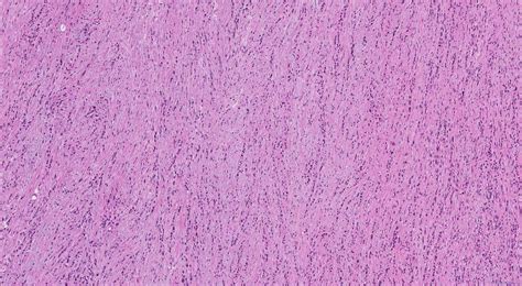 Goblet Cell Adenocarcinoma Archives Ottawa Atlas Of Pathology