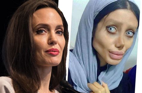 Botched Teen Gets 50 Plastic Surgeries To Look Like Angelina Jolie