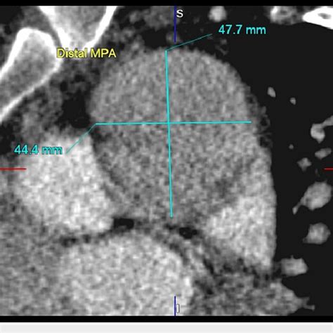 Aneurysm Of The Main Pulmonary Artery On Computed Tomography Angiogram