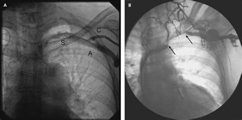 5 Techniques Of Pacemaker Implantation And Removal Thoracic Key