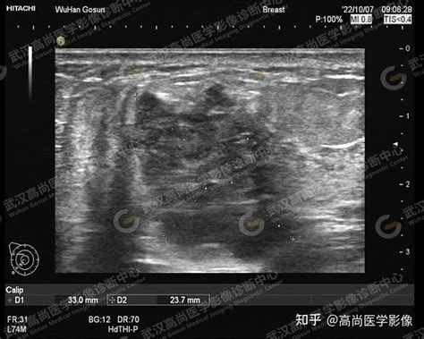 三例乳腺肿块超声诊断病例【高尚医学影像】 知乎