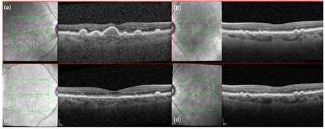Spectralis® Heidelberg Oct B Scans Showed A Presence Of Several Large