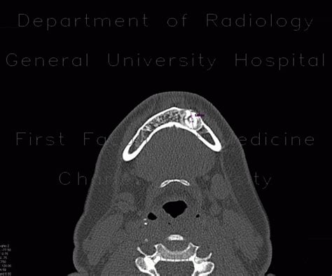 Radiology Case Odontoma