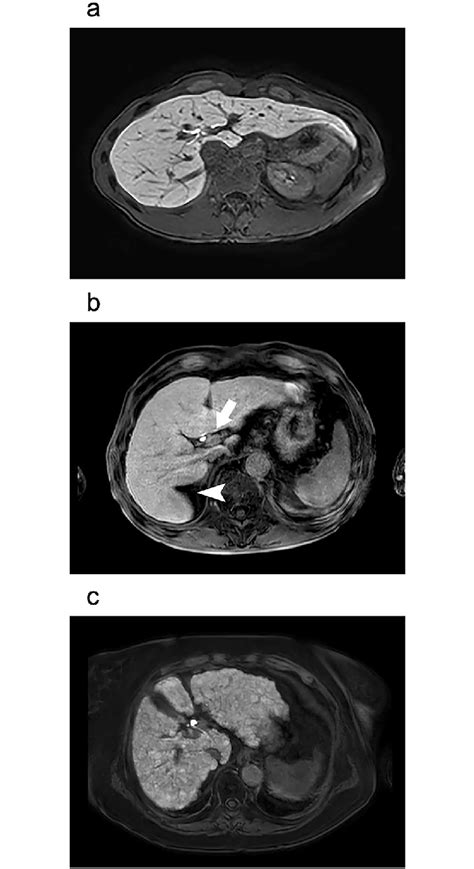 Assessment Of The Morphological Severity Of Cirrhosis Using Download Scientific Diagram
