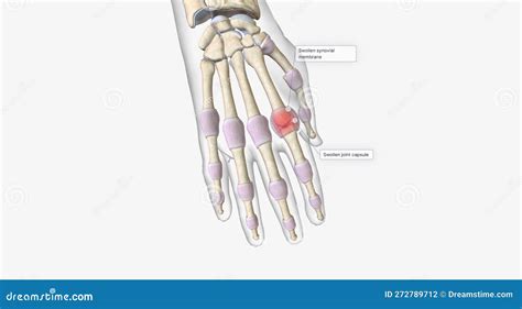 Early Rheumatoid Arthritis In Right 2nd Metacarpophalangeal Joint Stock