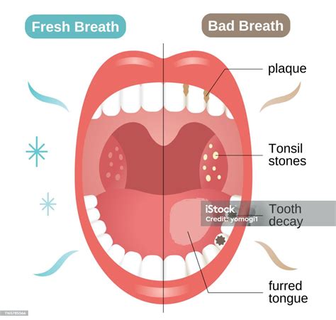 일러스트 레이션 전후에 나쁜 신선한 호흡 구강 관리 개념 입냄새에 대한 스톡 벡터 아트 및 기타 이미지 입냄새 박테리아 벡터 Istock