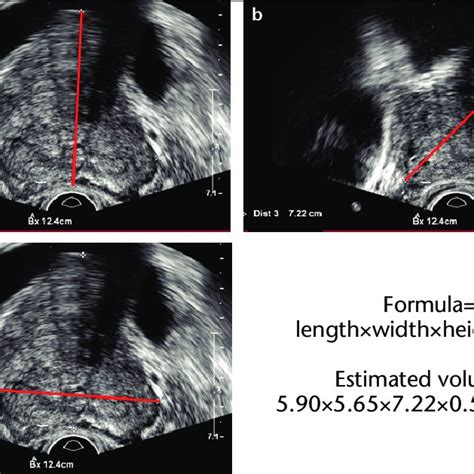 Pdf Clinical Value Of Prostate Segmentation And Volume Determination